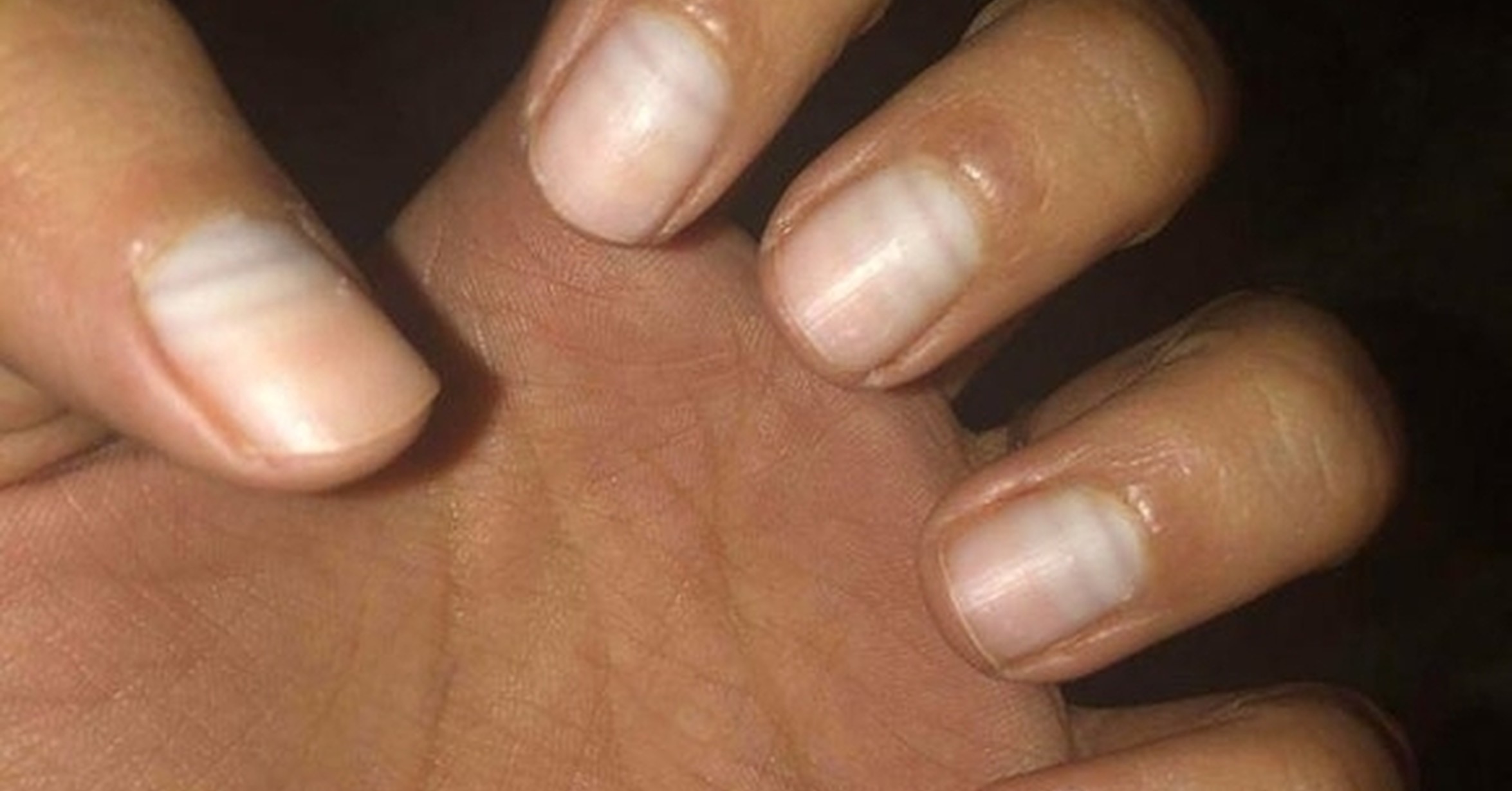 ¡Cuánta razón! / Los efectos de la quimio en las uñas